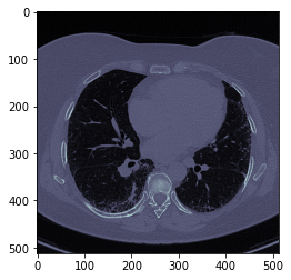 OSIC Pulmonary Fibrosis Progression - AI_ML_DL’s diary