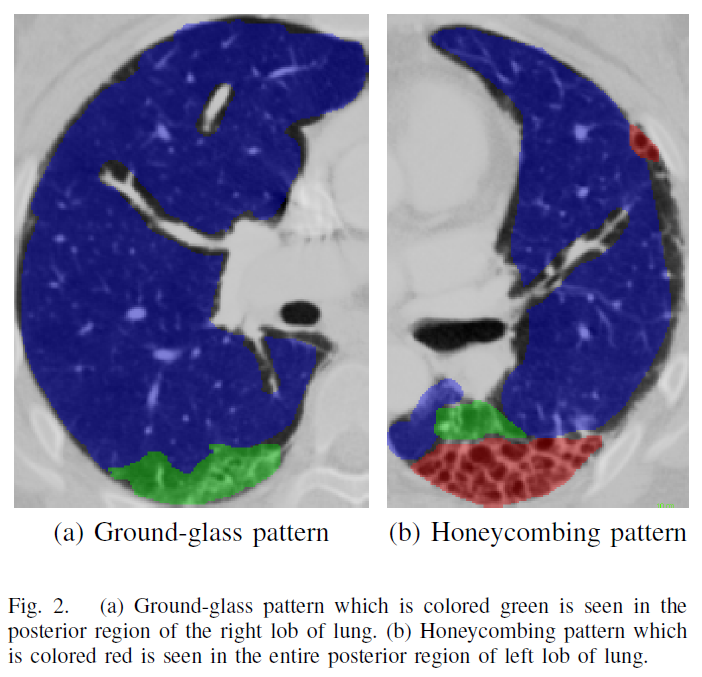OSIC Pulmonary Fibrosis Progression - AI_ML_DL’s diary