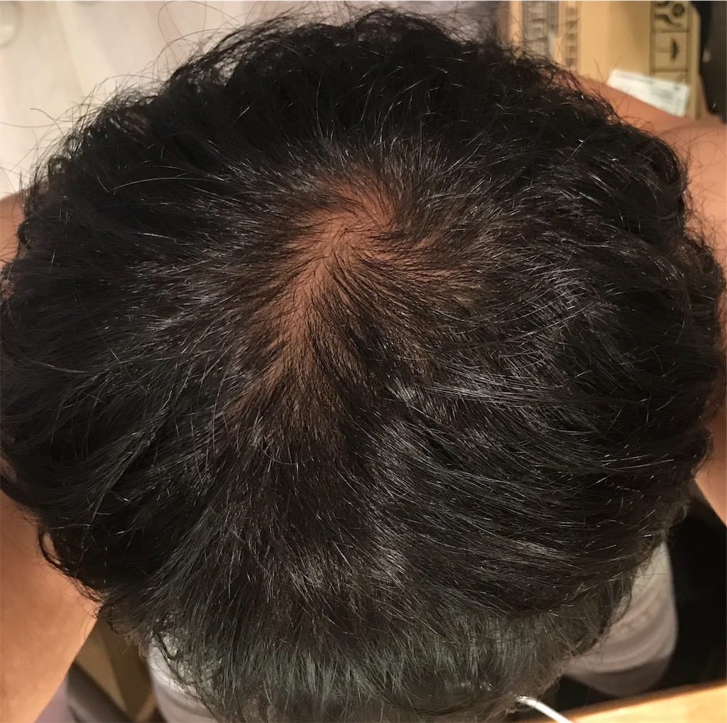 しらみ取りシャンプー 6日目 - 超人間主義者Aの日記