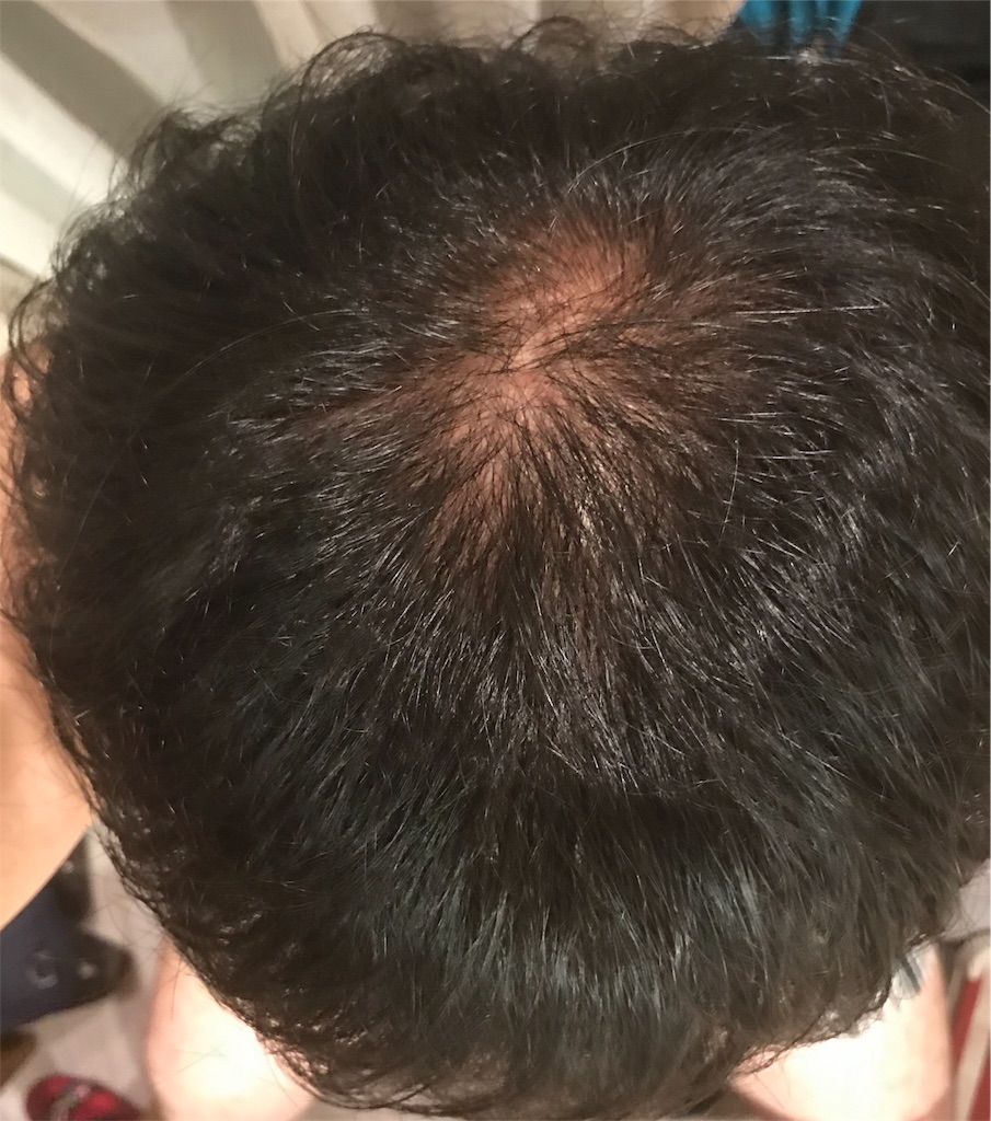 しらみ取りシャンプー 18日目 - 超人間主義者Aの日記