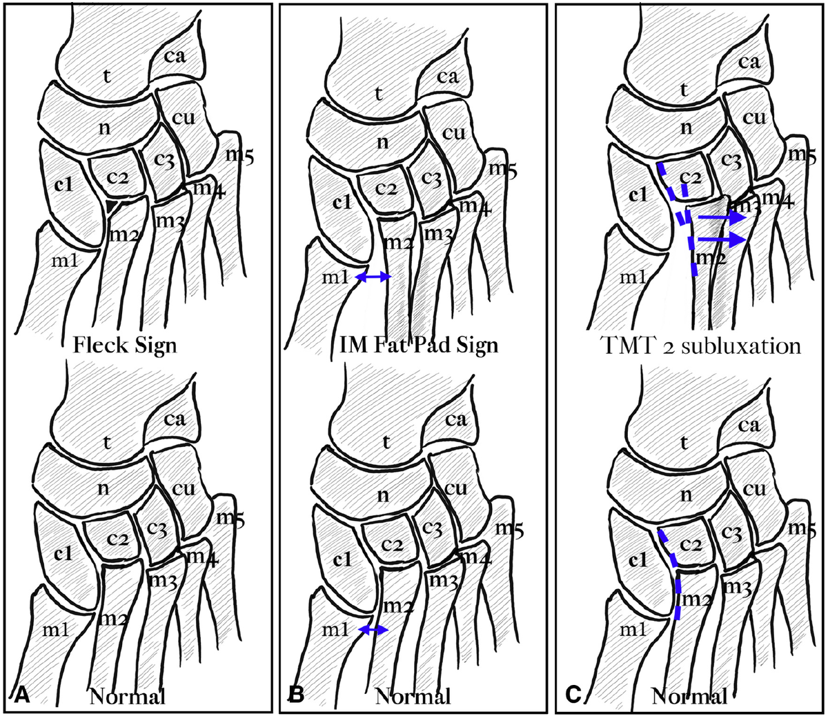 症例22：右足をサッカー中に「ひねって」受傷した21歳男性（J Emerg Med. 2020 Oct;59(4):e143-e147 ...