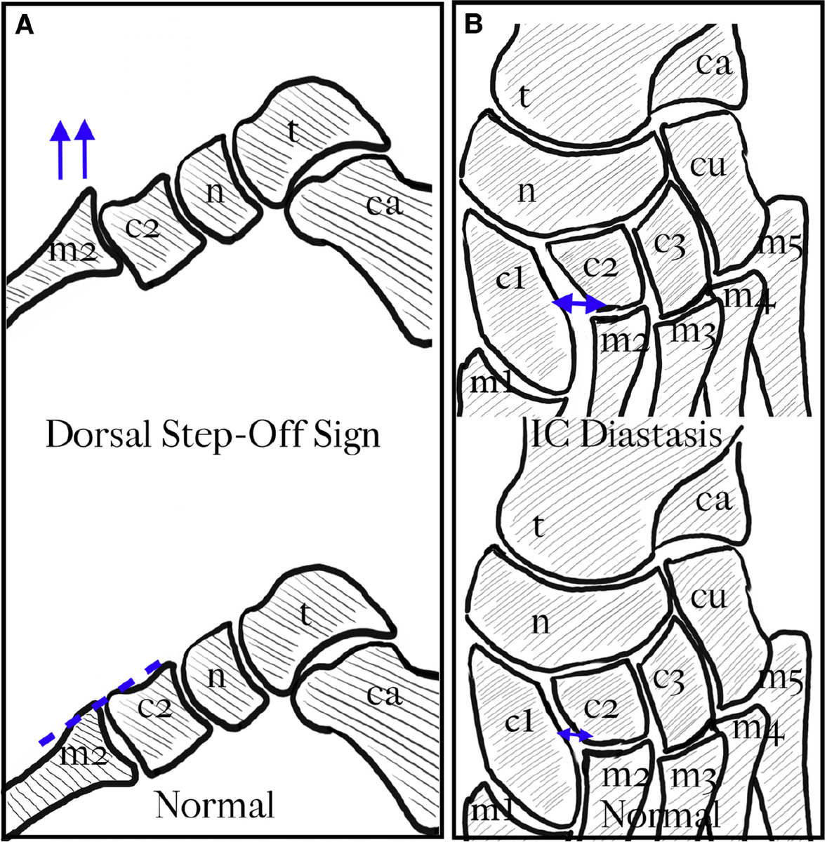 症例22：右足をサッカー中に「ひねって」受傷した21歳男性（J Emerg Med. 2020 Oct;59(4):e143-e147 ...