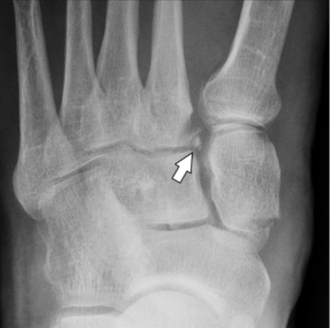 症例22：右足をサッカー中に「ひねって」受傷した21歳男性（J Emerg Med. 2020 Oct;59(4):e143-e147 ...