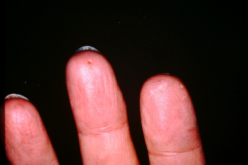 画像：指先の異常 - 膠原病・リウマチ一人抄読会