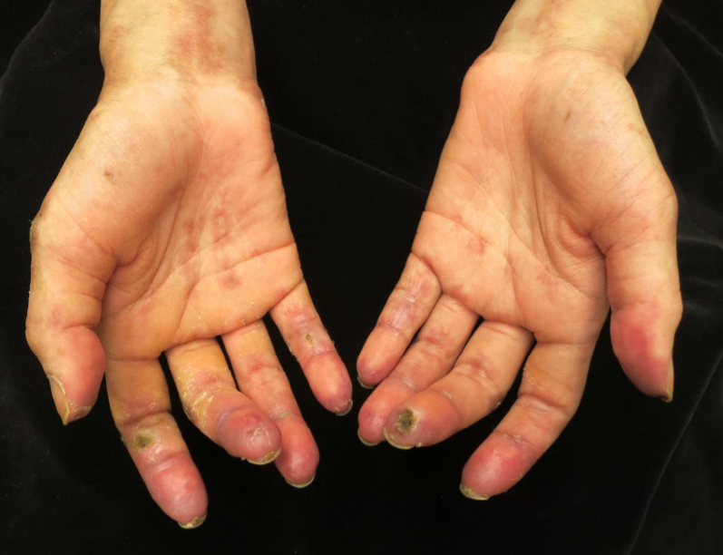 抗MDA5抗体陽性皮膚筋炎レビュー - 膠原病・リウマチ一人抄読会