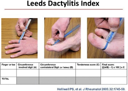 乾癬性関節炎におけるDactylitis（指炎） - 膠原病・リウマチ一人抄読会