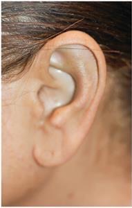 再発性多発軟骨炎レビュー - 膠原病・リウマチ一人抄読会