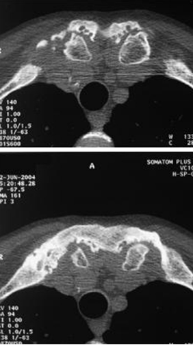 SAPHO症候群の診断・画像所見 - 膠原病・リウマチ一人抄読会