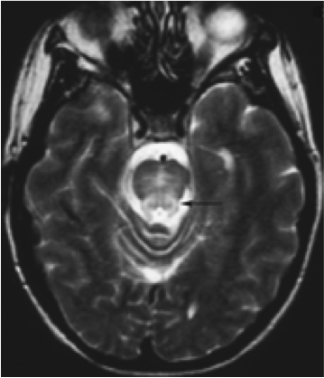 Wilson病②−検査 - Neurogeneralist