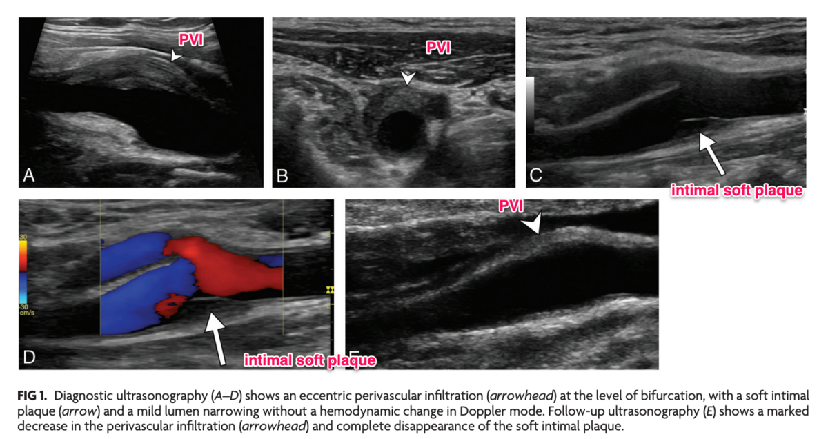 【まとめ】TIPIC症候群 - 膠原病内科日記