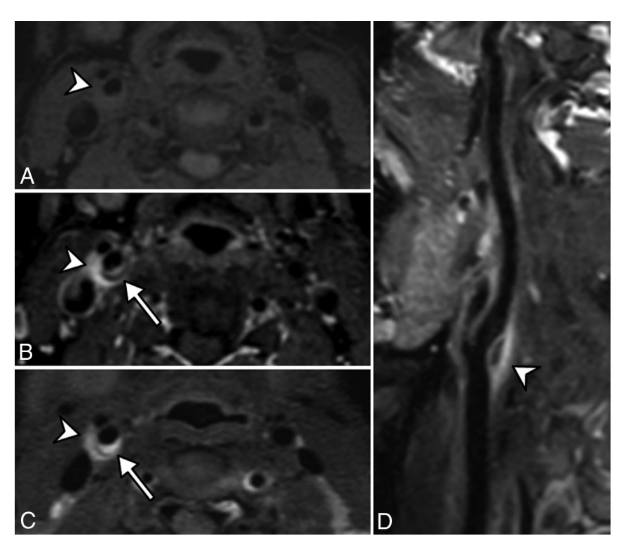 【まとめ】TIPIC症候群 - 膠原病内科日記
