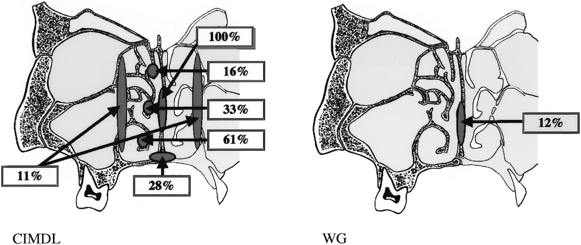 【まとめ】コカイン誘発性血管炎 - 膠原病内科日記