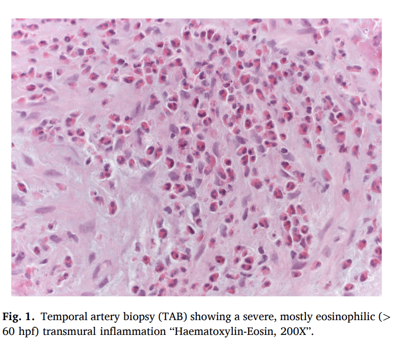 Eosinophilic Giant Cell Arteritis - 膠原病内科日記