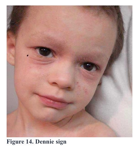 Hertoghe signについて - 都城鍼灸ジャーナル