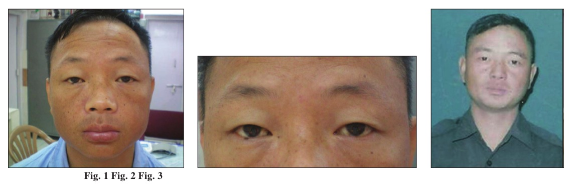 Hertoghe signについて - 都城鍼灸ジャーナル