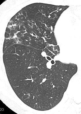 個別「びまん性汎細気管支炎（DPB）」の写真、画像 - タカ派の画像診断医 写真館