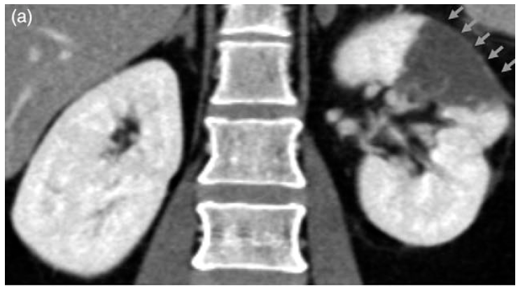腎梗塞 - okamotonojinzo