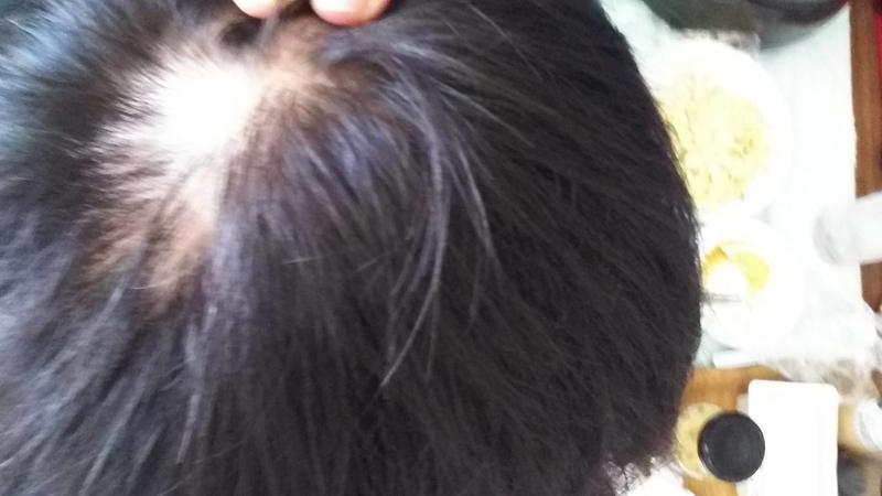 ハゲ その1 円形脱毛症 - うつDEBUハゲの奮闘日記