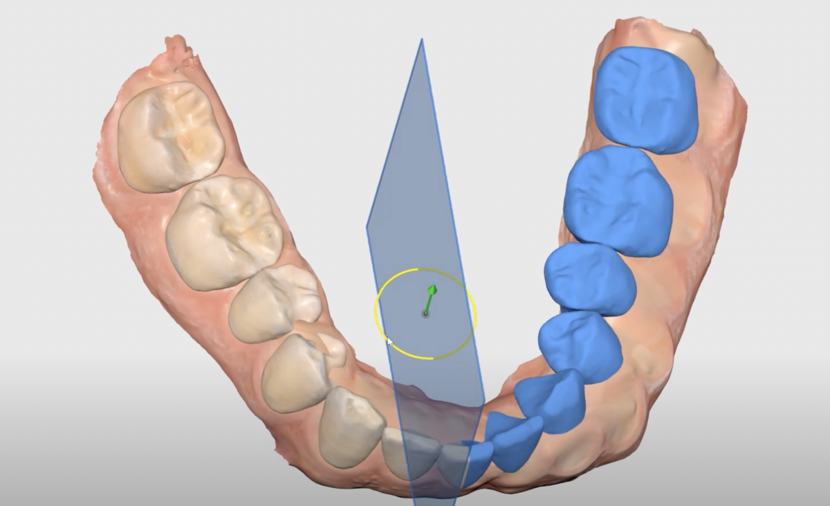 Medit Linkの簡易CADアドオンソフト Medit Design 2.1 アップデート レビュー①機能の紹介 - 3D歯科 のデジタル ...