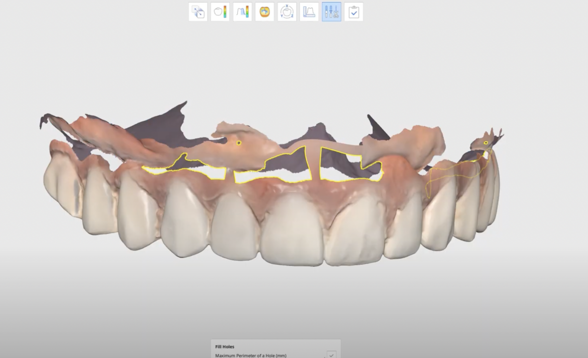Medit Linkの簡易CADアドオンソフト Medit Design 2.1 アップデート レビュー①機能の紹介 - 3D歯科 のデジタル ...