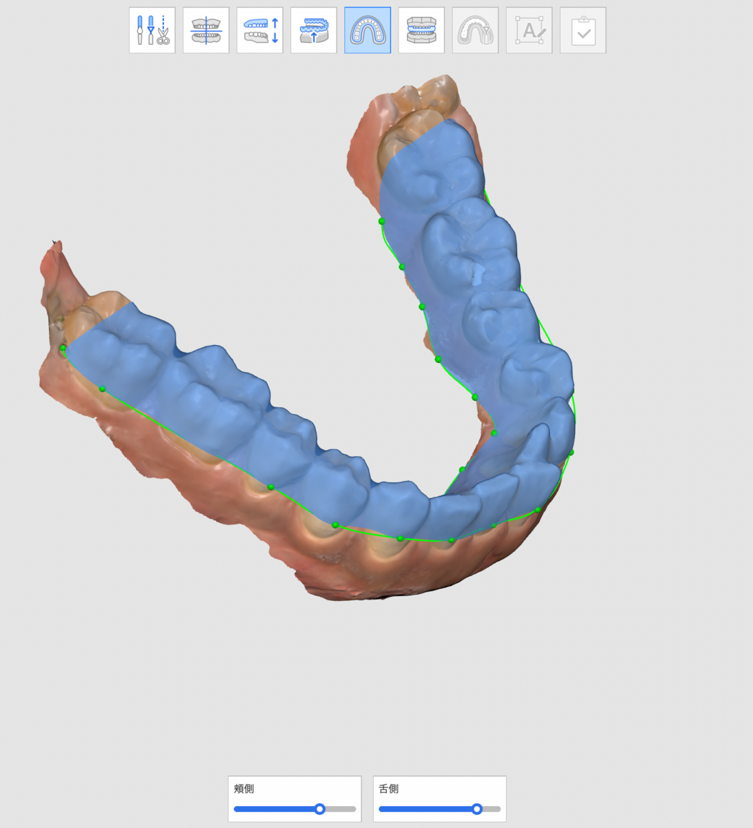 Medit SplintsとDesignで！矯正などで使用するCOPAスプリント、スタビリゼーションスプリントの製作 - 3D歯科 のデジタル ...