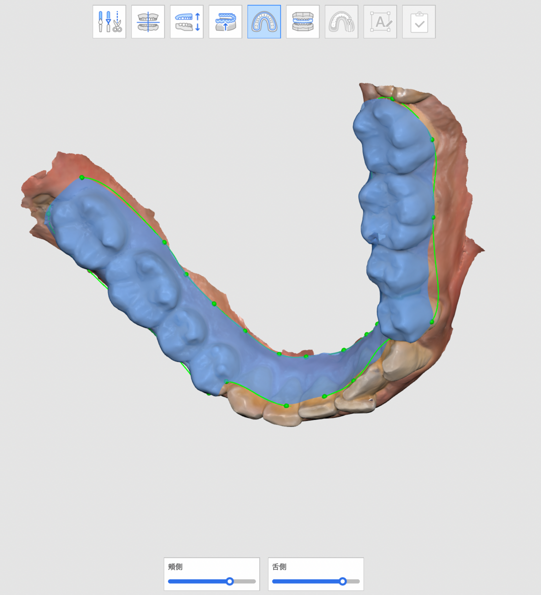 Medit SplintsとDesignで！矯正などで使用するCOPAスプリント、スタビリゼーションスプリントの製作 - 3D歯科 のデジタル ...