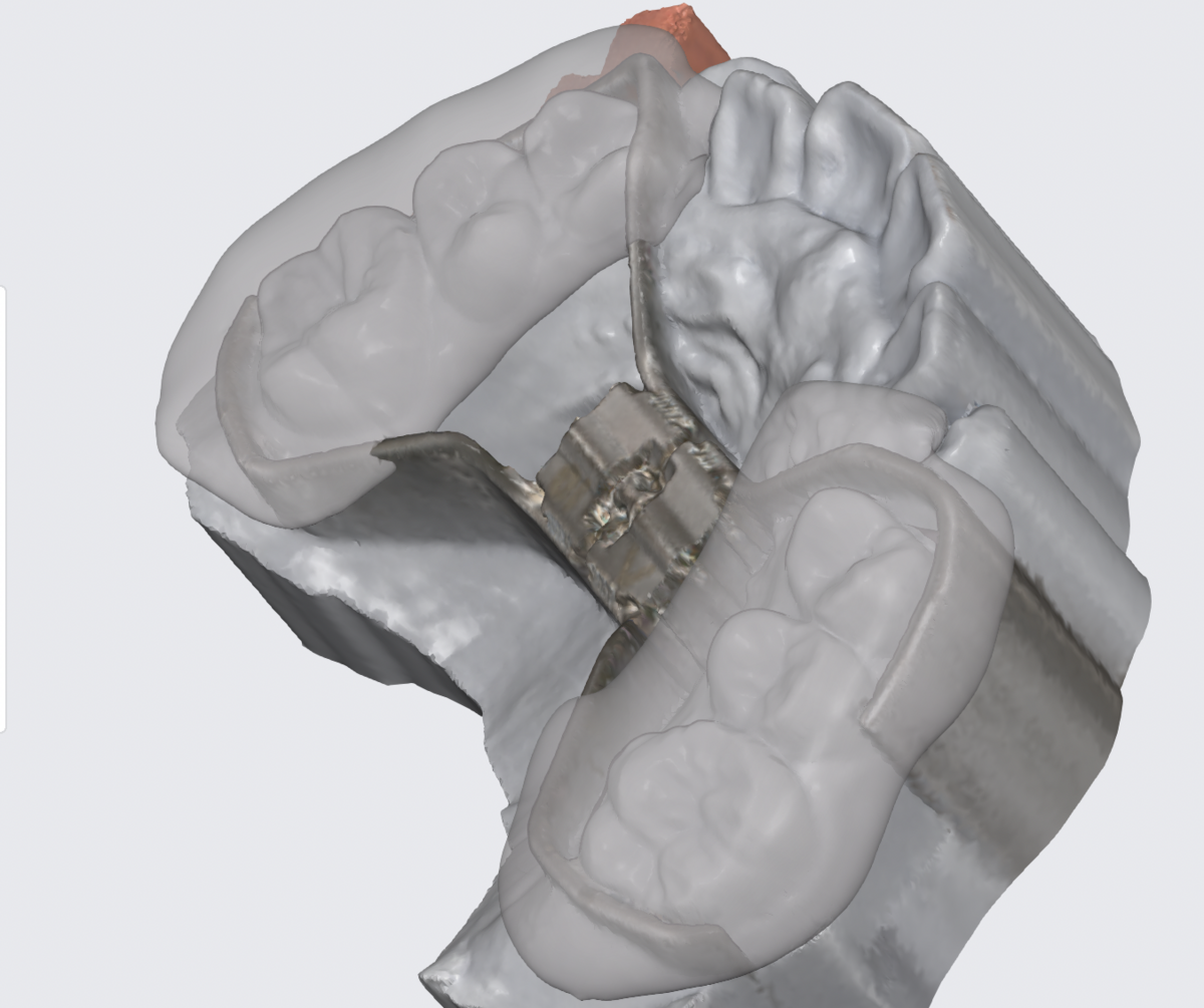 Medit SplintsとDesignで！矯正などで使用するCOPAスプリント、スタビリゼーションスプリントの製作 - 3D歯科 のデジタル ...
