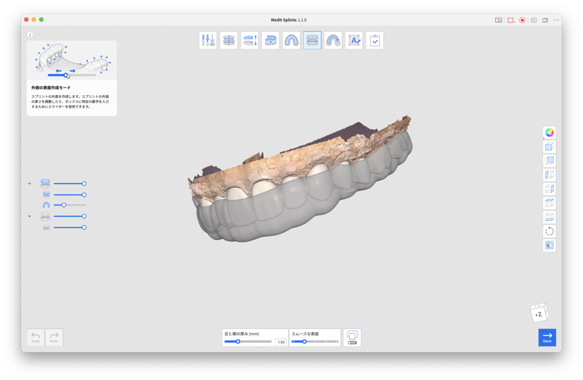 Medit Splints 1.1 アップデート スプリント以外にも使えます！ - 3D歯科 のデジタル歯医者入門