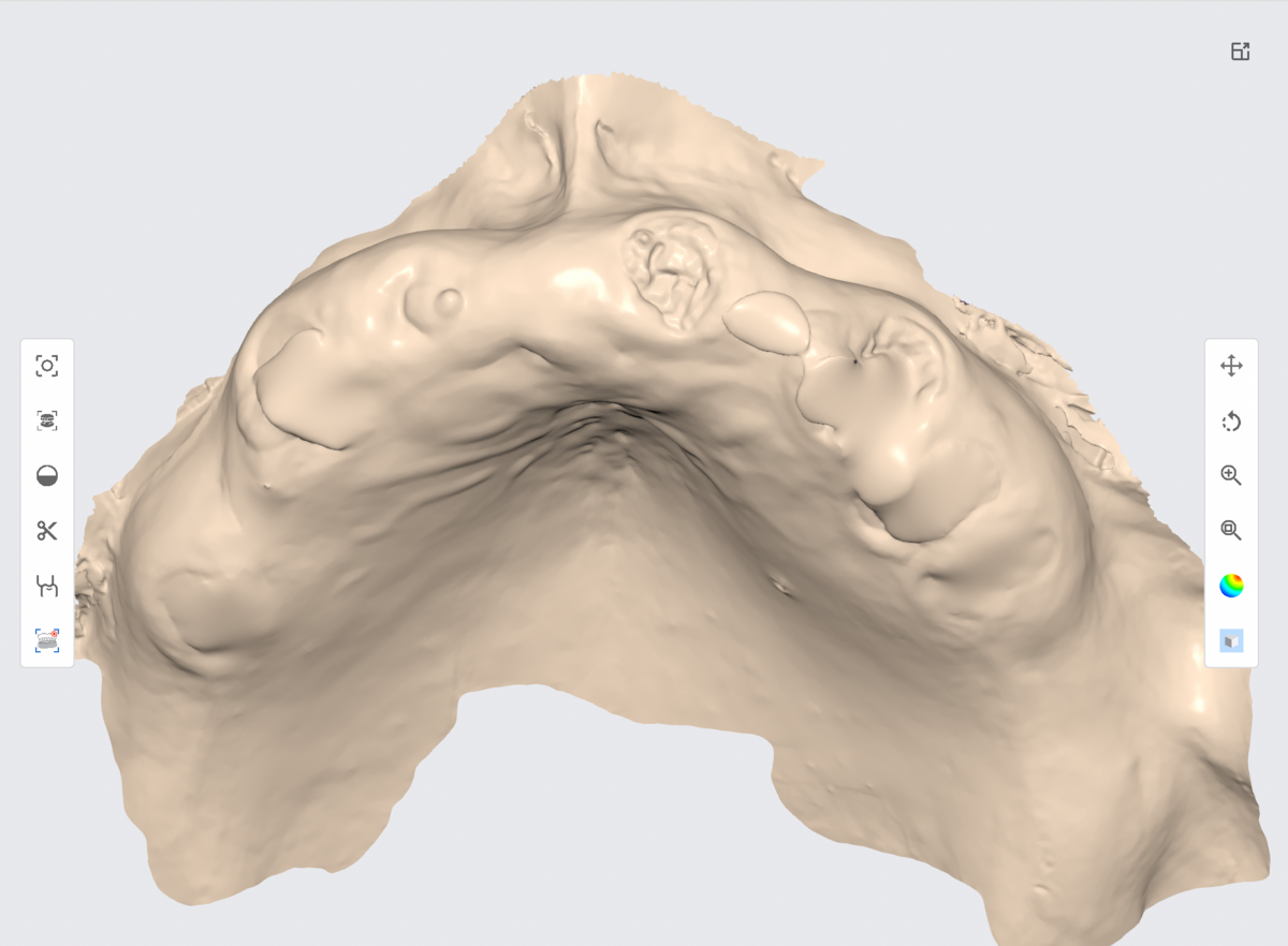 Medit Splints 1.1 アップデート スプリント以外にも使えます！ - 3D歯科 のデジタル歯医者入門