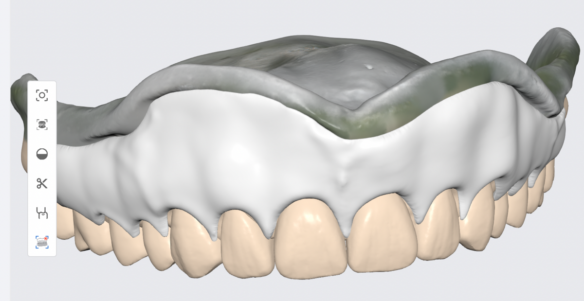 3Dプリントデンチャーの歯肉・歯冠をズレなく接着するために③「ベニアデンチャー」のススメ（Medit Splints使用） - 3D歯科 の ...