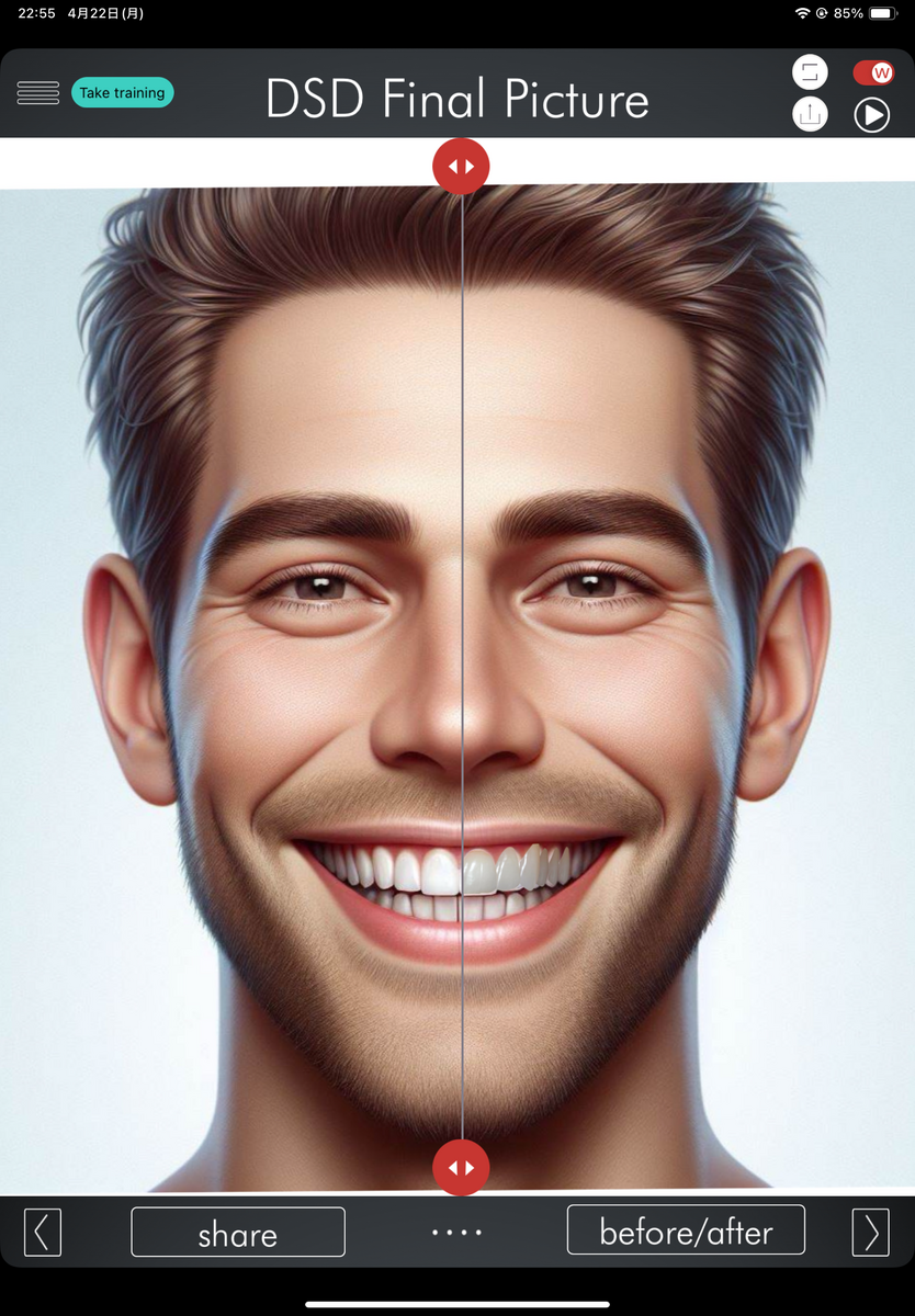 DSD Appが無料に！簡単（？）にスマイルデザインをiPadで - 3D歯科 のデジタル歯医者入門