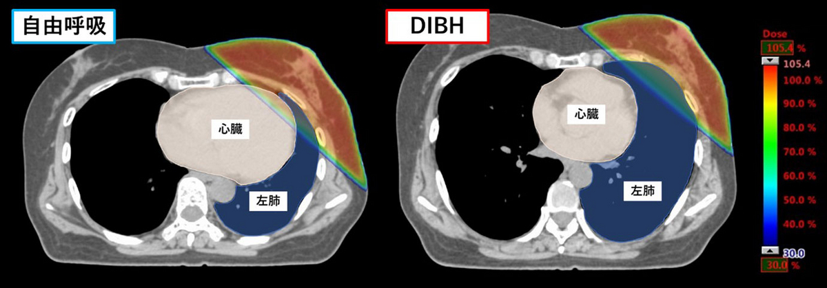 放射線照射時に肺が心臓に幅寄せ（Deep Inspiration Breath Hold; DIBH） - 季節めぐり