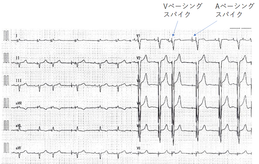 ペースメーカーの基本 - 循環器内科医の本棚