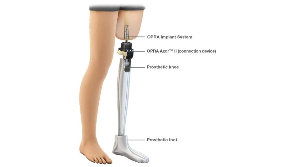 骨直結型義足（Osseointegrated prosthesis） - 義足と義手のリハビリテーション