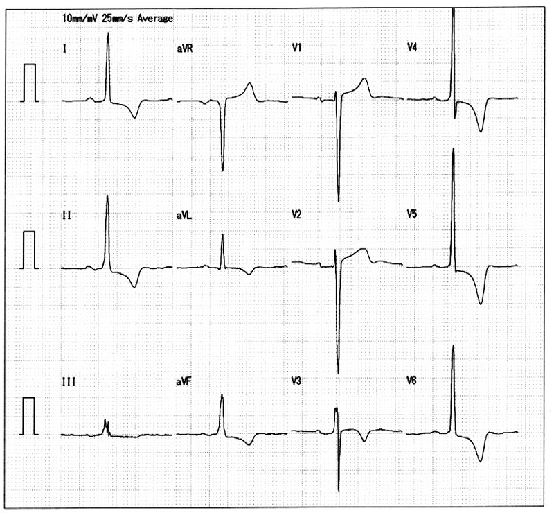 ECG-036：39才女性。高血圧・SAHで搬入され手術へ - heart2019改 の ECG-001 〜 ECG-315 まで移転です。