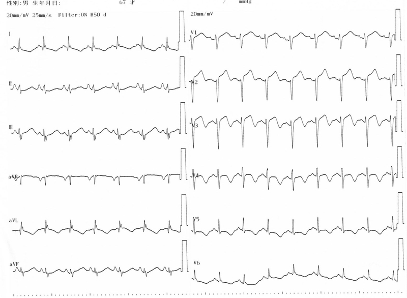ECG-055：67才男性。CPA治療後の心電図です。 - heart2019改 の ECG-001 〜 ECG-315 まで移転です。