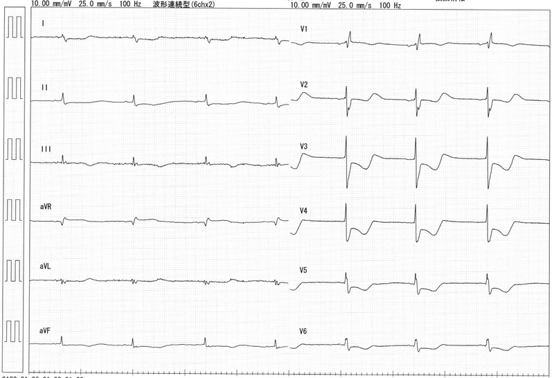 ECG-065：85才女性。突然のCPA - heart2019改 の ECG-001 〜 ECG-315 まで移転です。