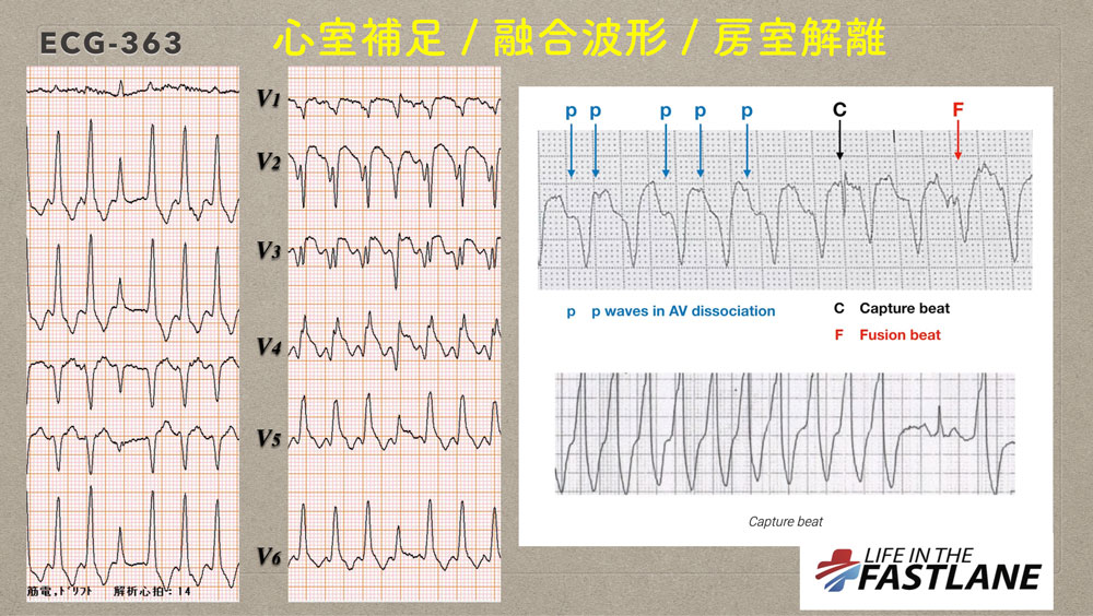 ECG-363：answer その3 VTらしい波形のいろいろ= 心電図検定試験：傾向と対策 Q.011 = - Cardio2012のECG ...