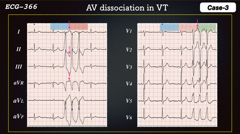 ECG-366：VTにおける、美しい房室解離波形を知りましょう= 心電図検定試験：傾向と対策 Q.013= - Cardio2012のECG ...