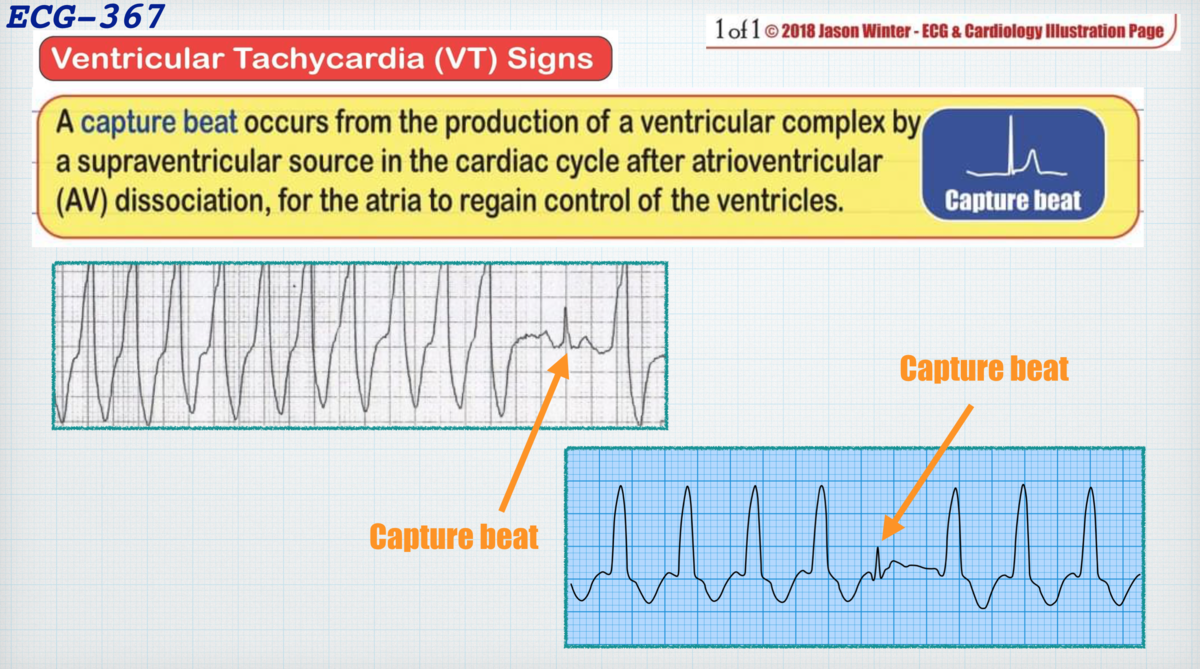 ECG-367：VT診断のためのTips その1= 心電図検定試験：傾向と対策 Q.014= - Cardio2012のECGブログ-2019改