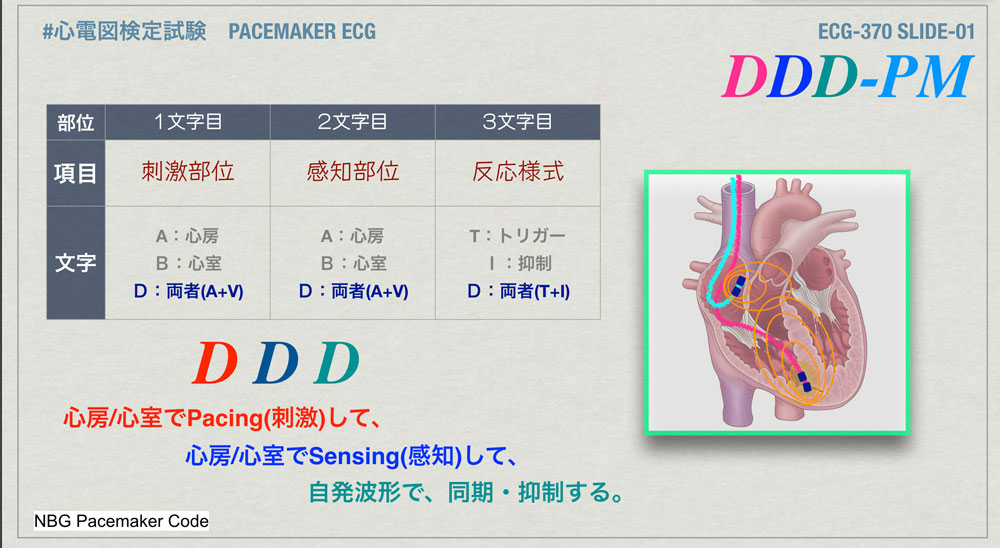 ECG-370：PaceMakerの12誘導心電図：DDD-PM = 心電図検定試験：傾向と対策 Q.016 = - Cardio2012の ...