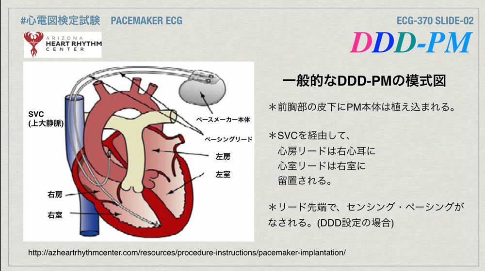ECG-370：PaceMakerの12誘導心電図：DDD-PM = 心電図検定試験：傾向と対策 Q.016 = - Cardio2012の ...