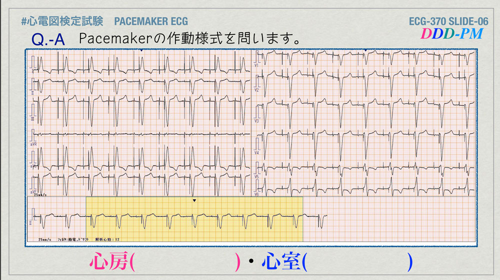ECG-370：answer - Cardio2012のECGブログ-2019改