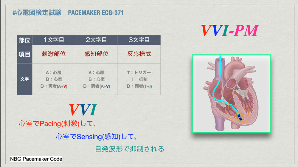 ECG-371：めまいとふらつきとVVI-pacemaker= 心電図検定試験：傾向と対策 Q.017 = - Cardio2012のECG ...