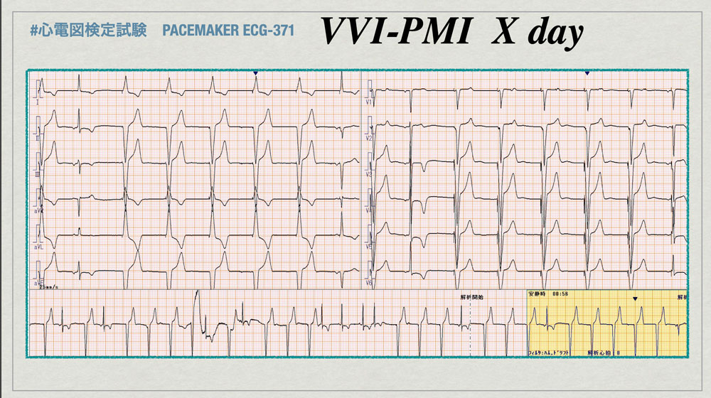 ECG-371：めまいとふらつきとVVI-pacemaker= 心電図検定試験：傾向と対策 Q.017 = - Cardio2012のECG ...
