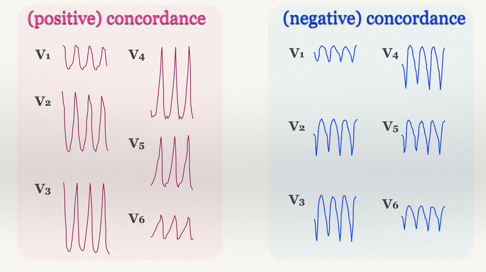 コラム：心電図を説明するイラスト集(freeです)-その3：VT編です。 - Cardio2012のECGブログ-2019改