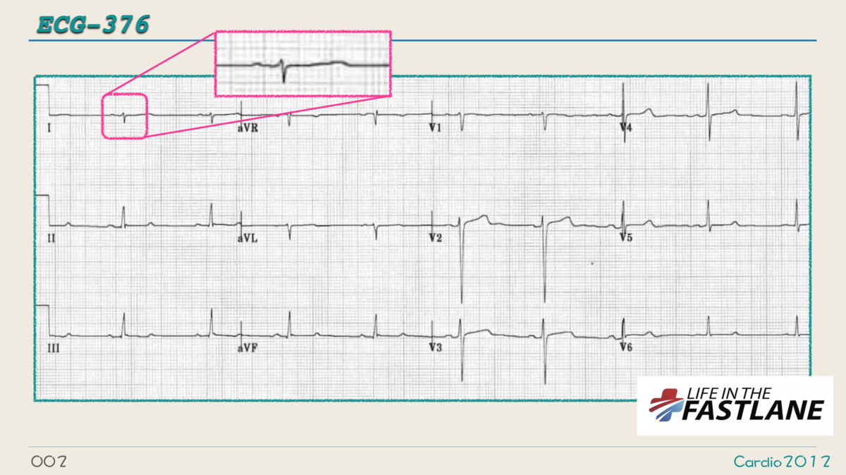 ECG-376：answer その1 LPHBと鑑別すべき病態 (#心電図検定試験-021) - Cardio2012のECGブログ-2019改
