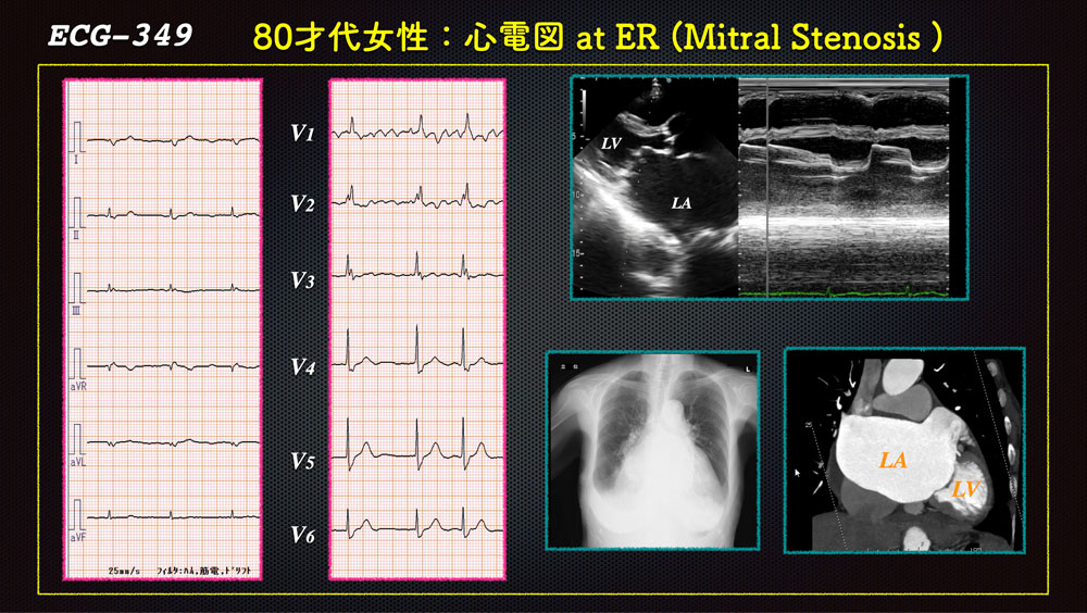 ECG-376：answer その1 LPHBと鑑別すべき病態 (#心電図検定試験-021) - Cardio2012のECGブログ-2019改