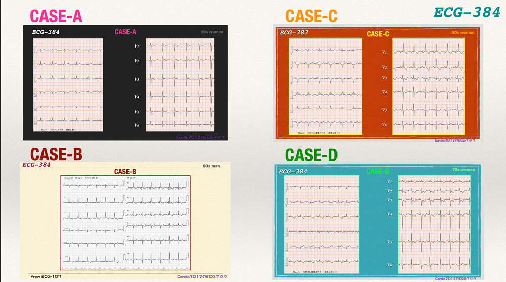 ECG-384： answer(1/2) #心電図検定試験-Question-9 肺高血圧症でないのは、どれでしょう。 - Cardio2012のECGブログ-2019改