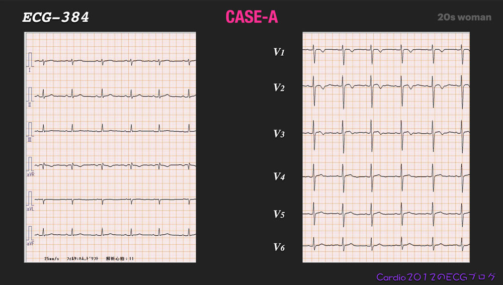 ECG-384： #心電図検定試験-Question-9 肺高血圧症でないのは、どれでしょう。 - Cardio2012のECGブログ-2019改